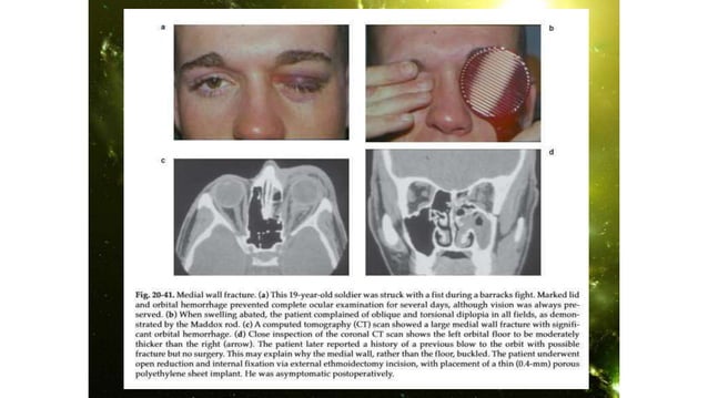 Orbital trauma | PPTX