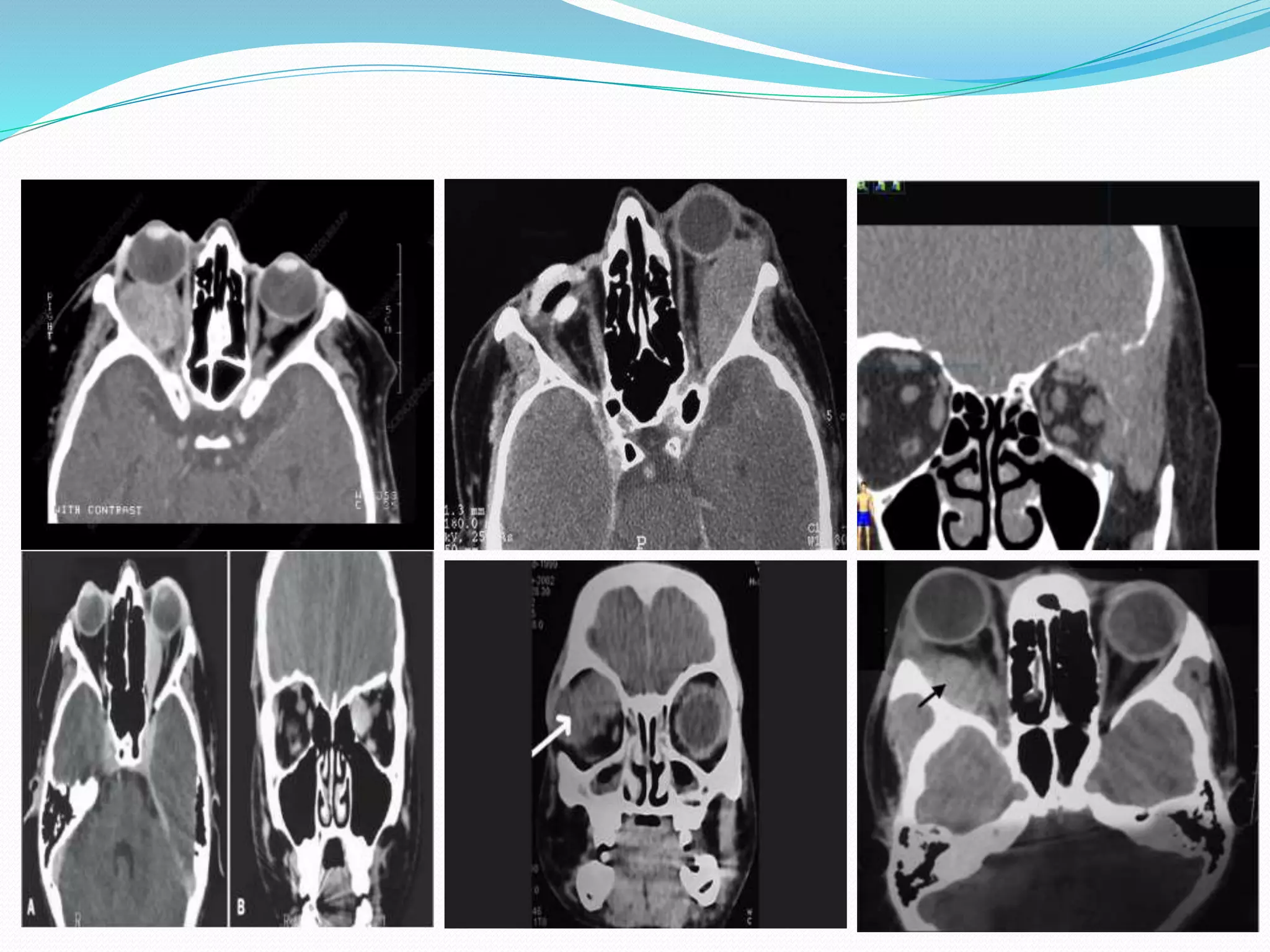 Orbital tumor (case presentation)dr.mumtaz ali | PPTX