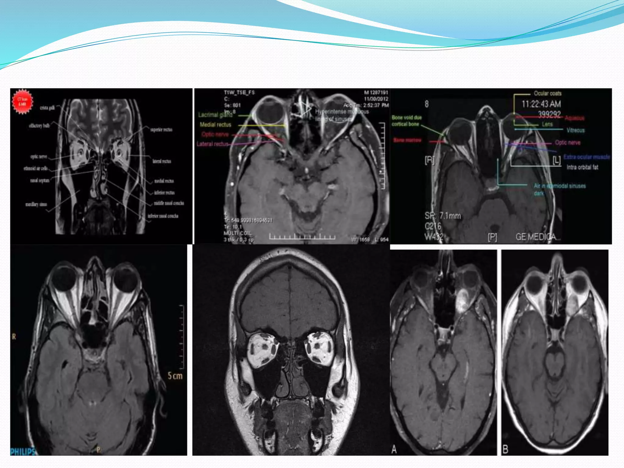 Orbital tumor (case presentation)dr.mumtaz ali | PPTX