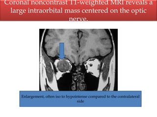 Orbital tumors | PPTX