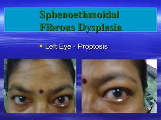 Endoscopic Approach to Orbit and Pituitary | PPT