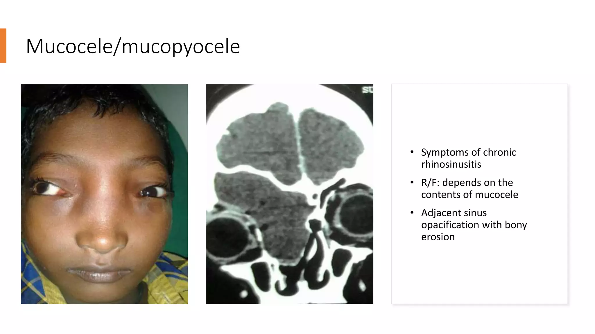 Orbital tumors.pptx
