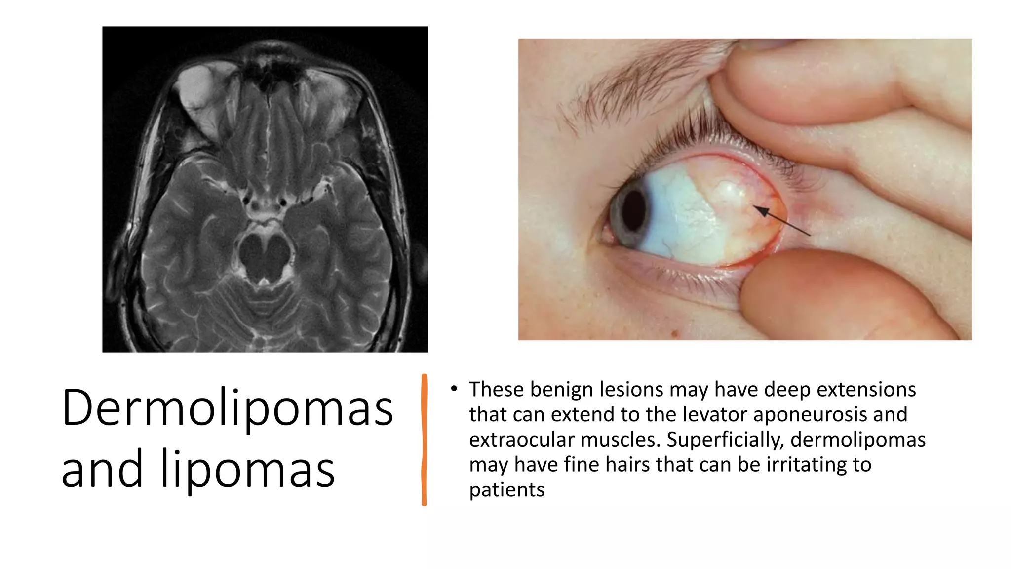 Orbital tumors.pptx