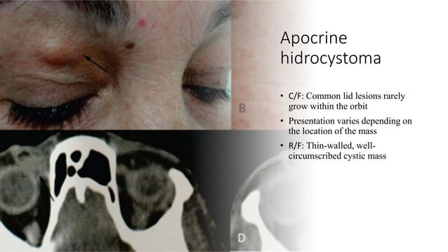 Orbital tumors.pptx