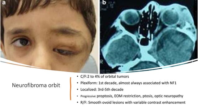 Orbital tumors.pptx