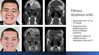 Orbital tumors.pptx