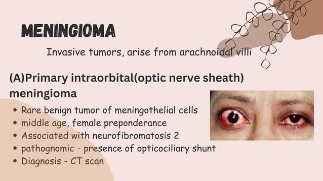 Orbital tumors in Opthalmology.......... | PPT