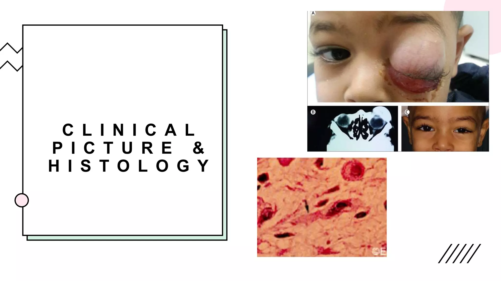 Orbital tumors | PPTX