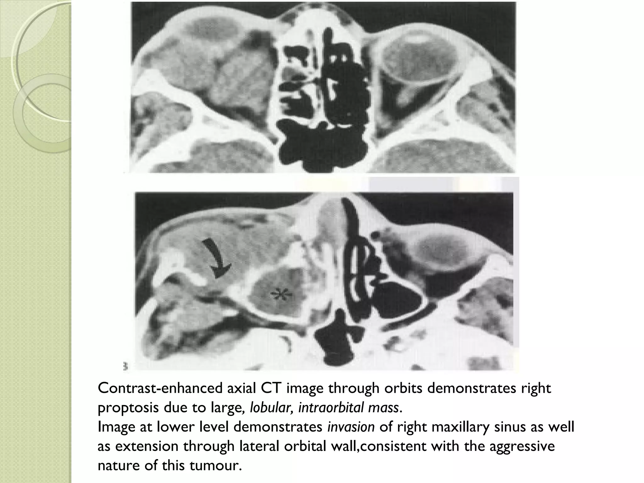 Orbital tumours | PPT