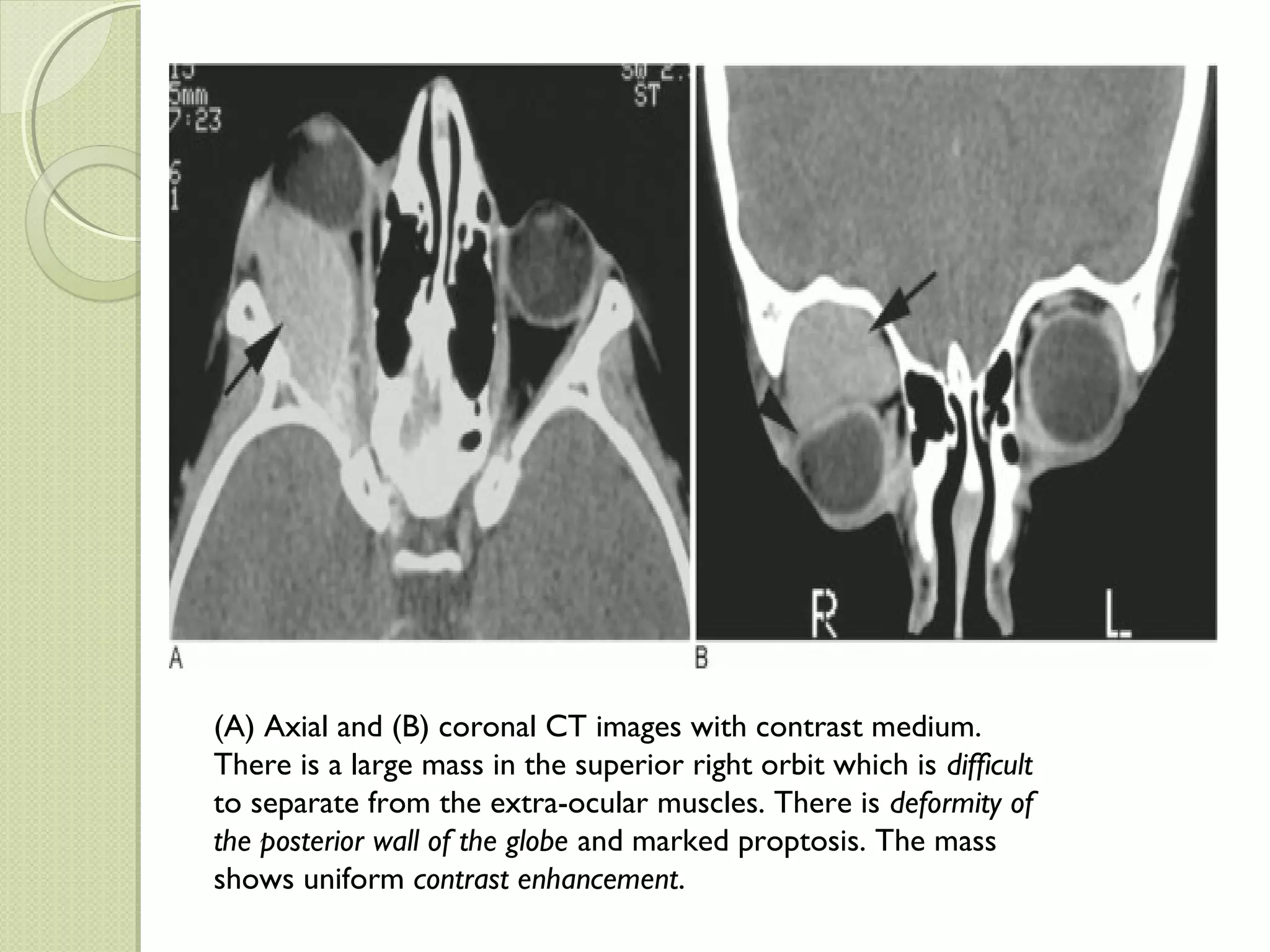 Orbital tumours | PPT