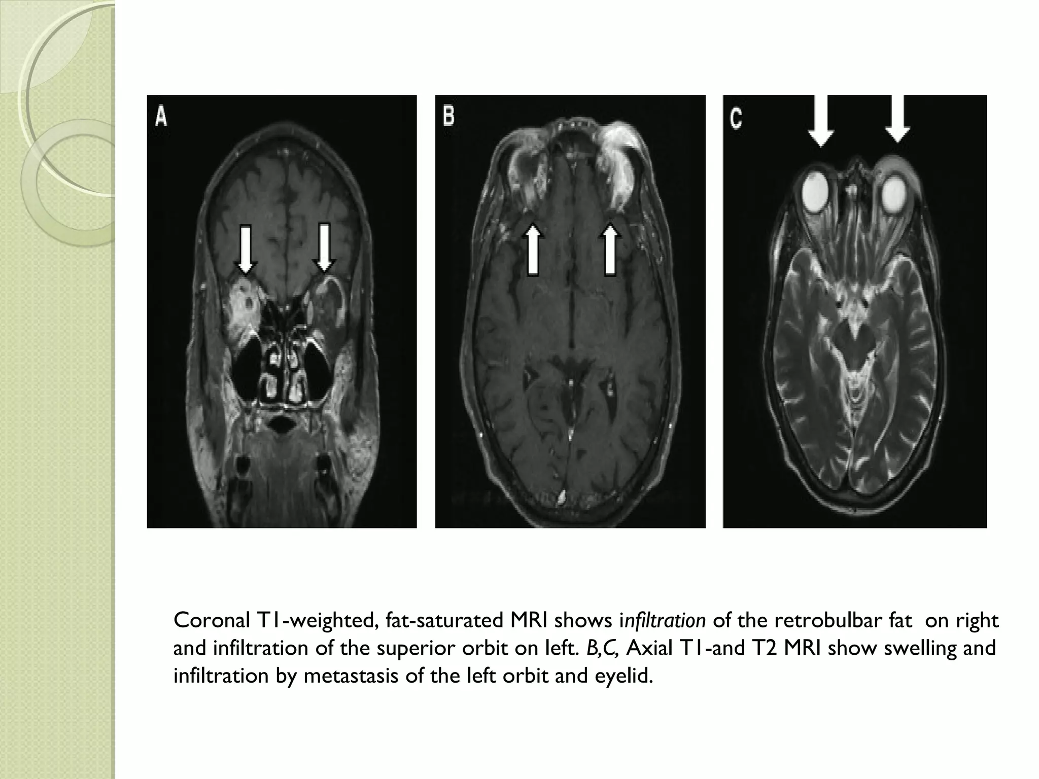 Orbital tumours | PPT
