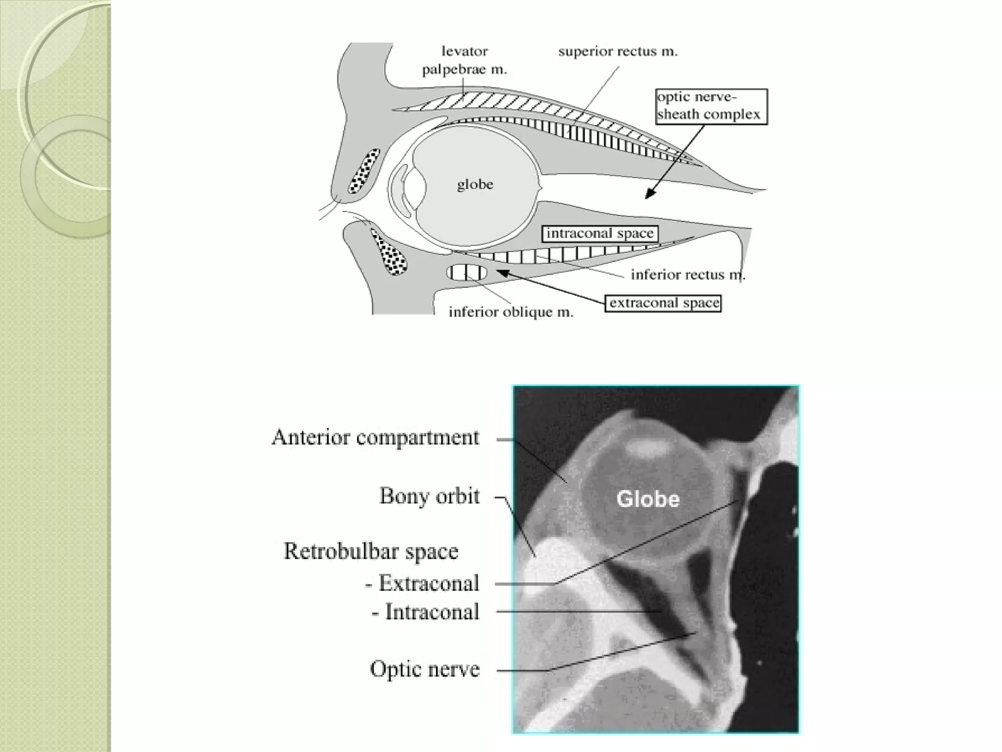 Orbital tumours | PPT