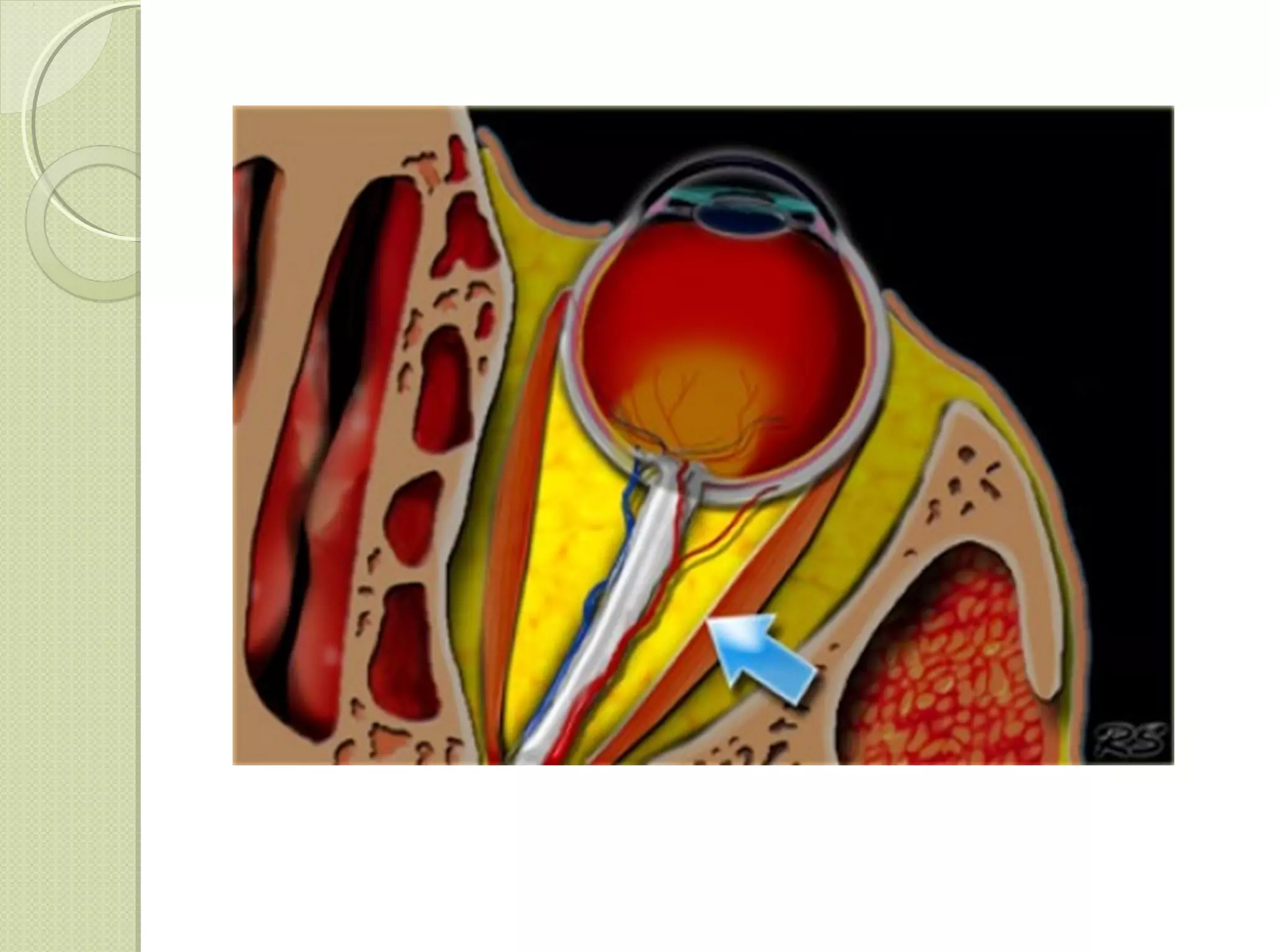 Orbital tumours | PPT