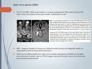 imaging of Orbital tumours | PPTX