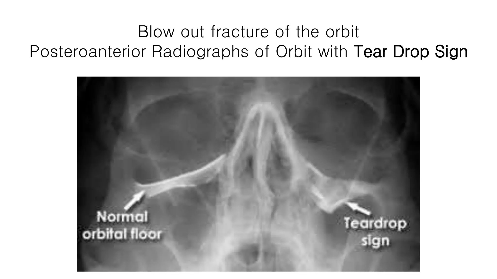 Orbit Anatomy and Surgical Spaces | PPTX