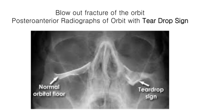 Orbit Anatomy and Surgical Spaces | PPTX | Ear, Nose and Throat ...