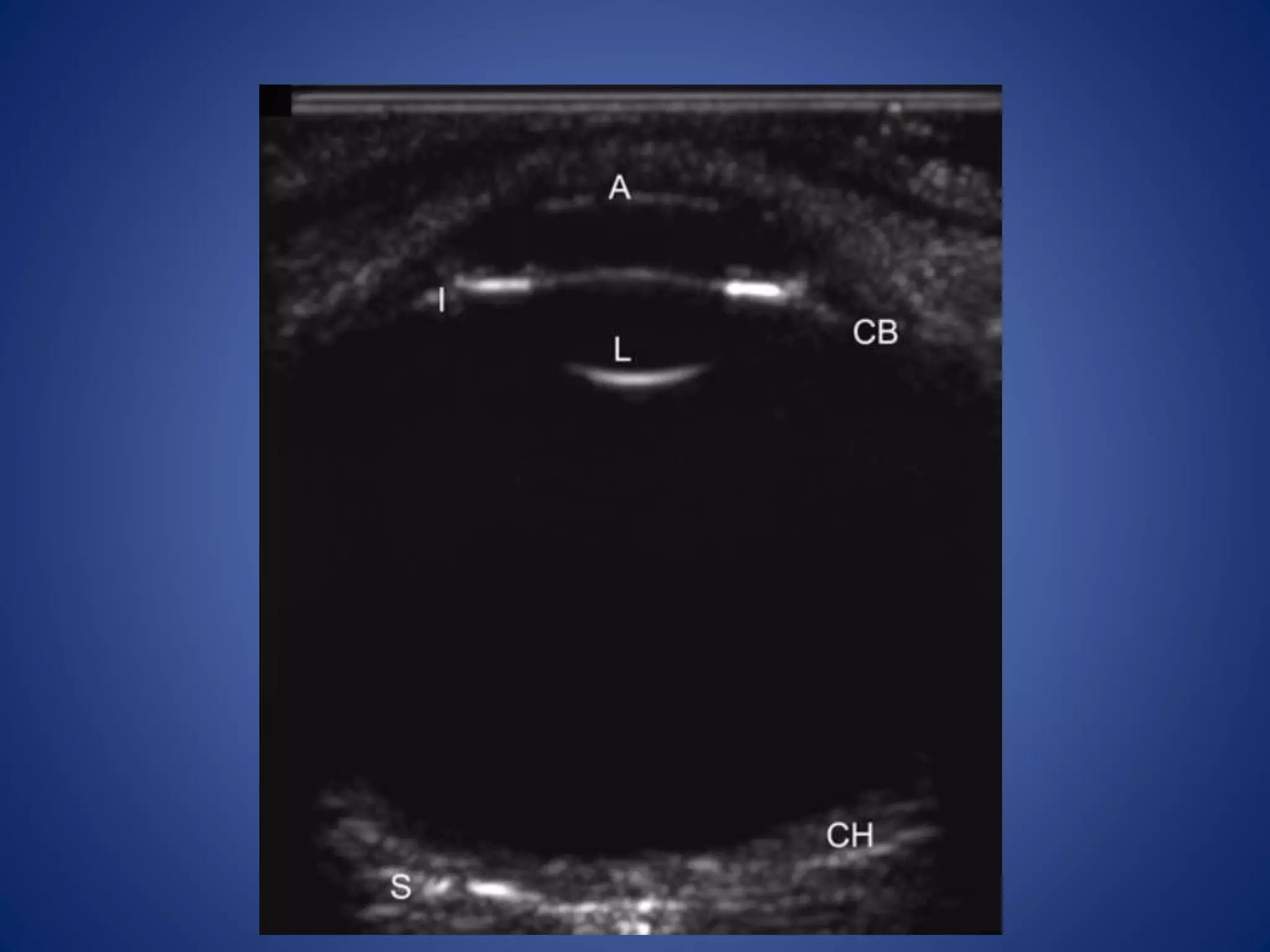Orbit imaging anatomy | PPTX