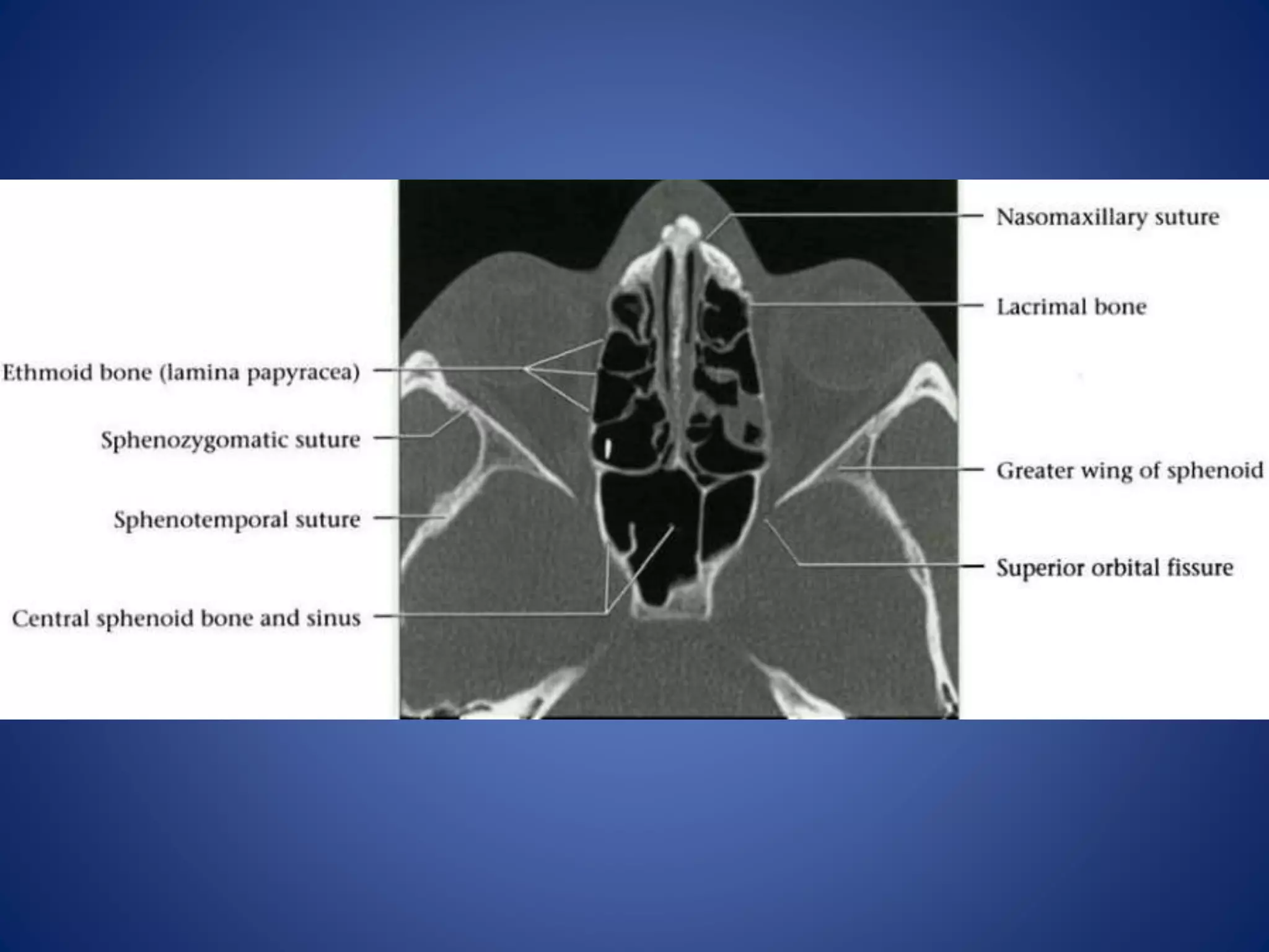 Orbit imaging anatomy | PPTX