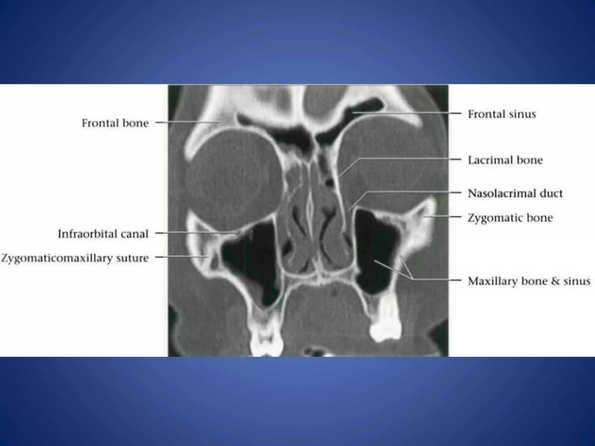 Orbit imaging anatomy | PPTX
