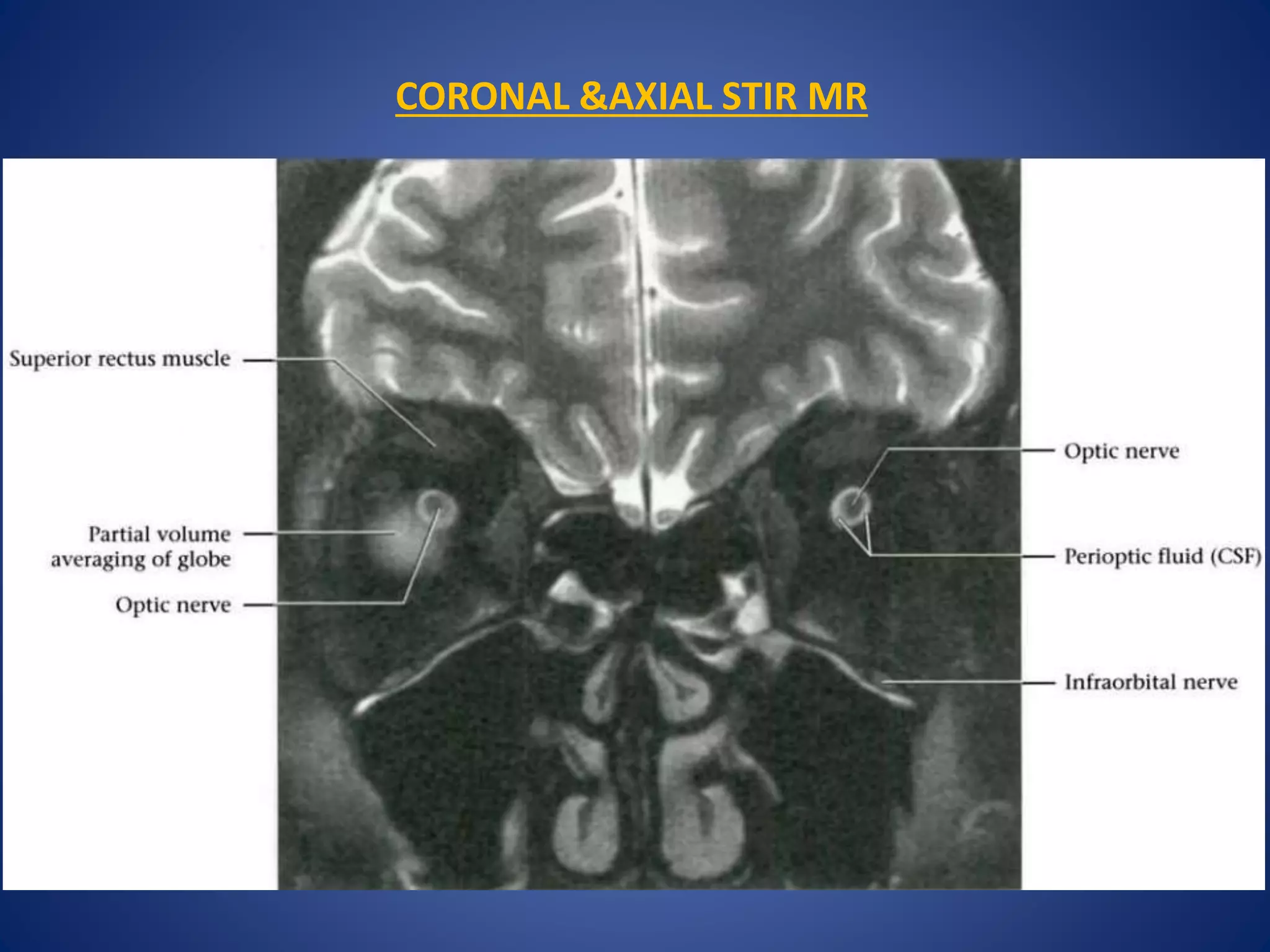 Orbit imaging anatomy | PPTX
