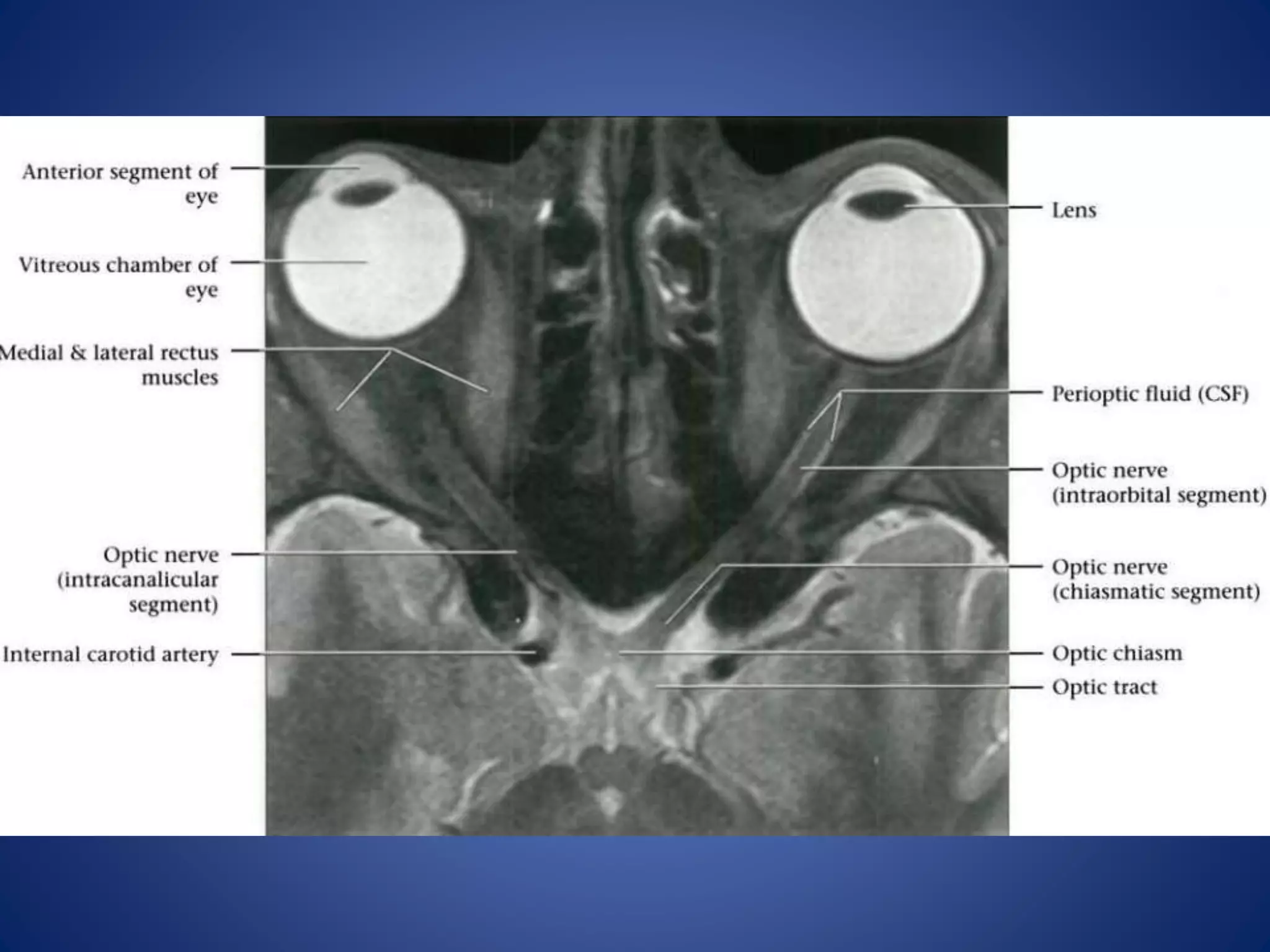 Orbit imaging anatomy | PPTX