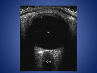 Orbit imaging anatomy | PPTX
