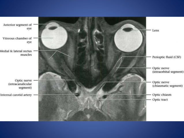 Orbit imaging anatomy | PPTX | Eye and Vision Conditions | Diseases and ...