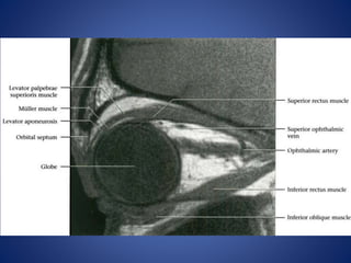 Orbital Septum Radiology