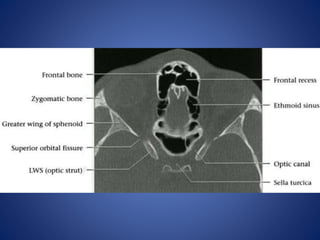 Superior Orbital Fissure Radiology