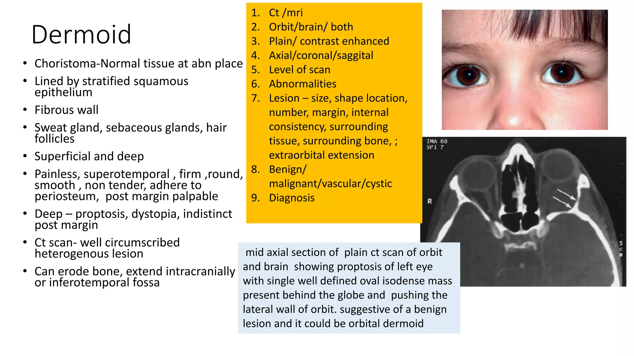 anatomy of orbital spaces, tumours and its importance | PDF