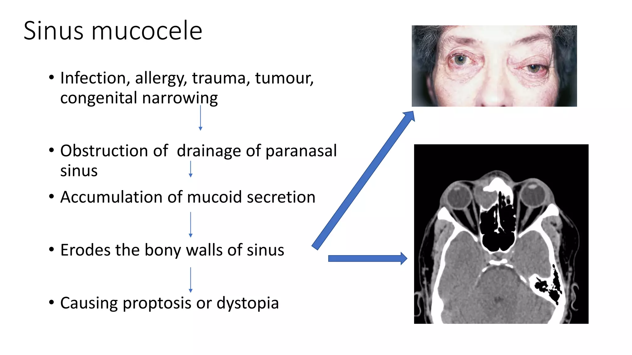 anatomy of orbital spaces, tumours and its importance | PDF