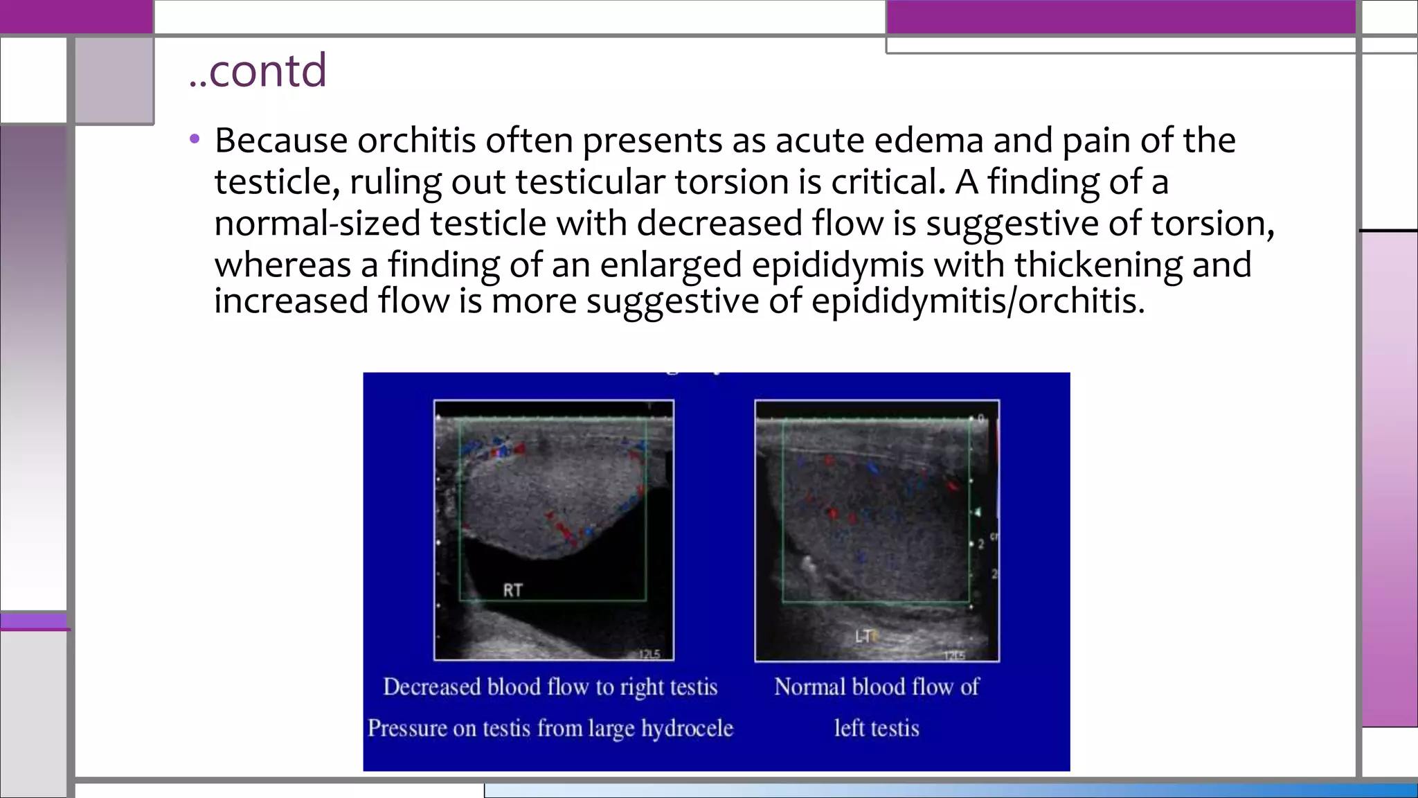 Orchitis And Epididymitis Ppt