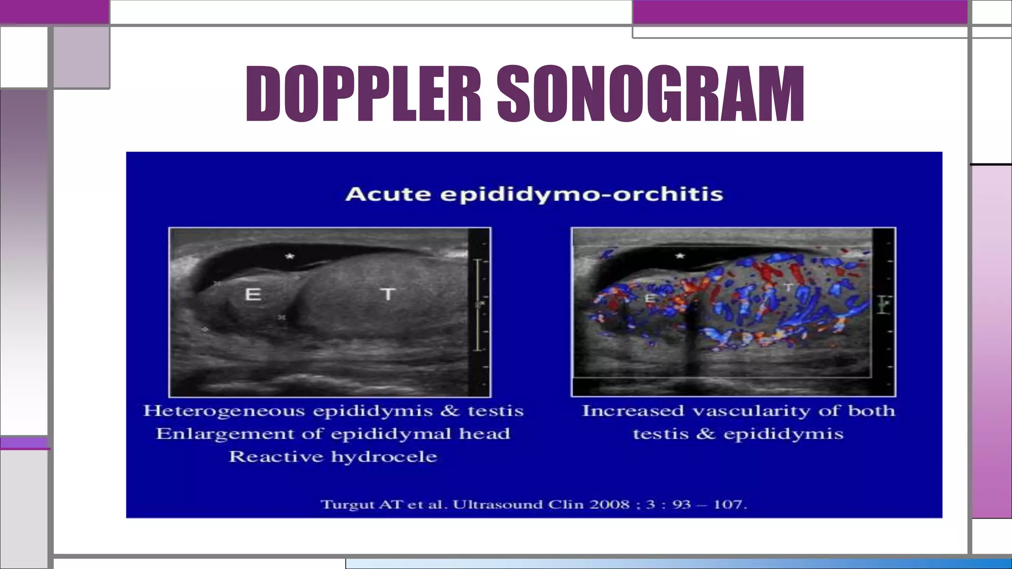 Orchitis & epididymitis | PPTX