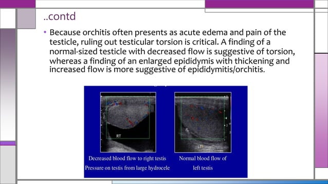Orchitis & epididymitis | PPTX | Sexual Conditions | Sexual Health