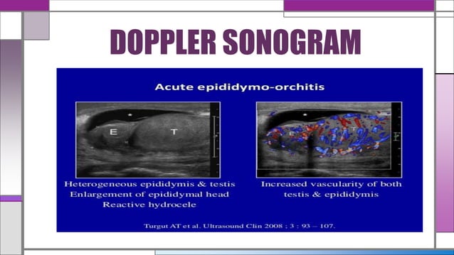 Orchitis & epididymitis | PPTX | Sexual Conditions | Sexual Health