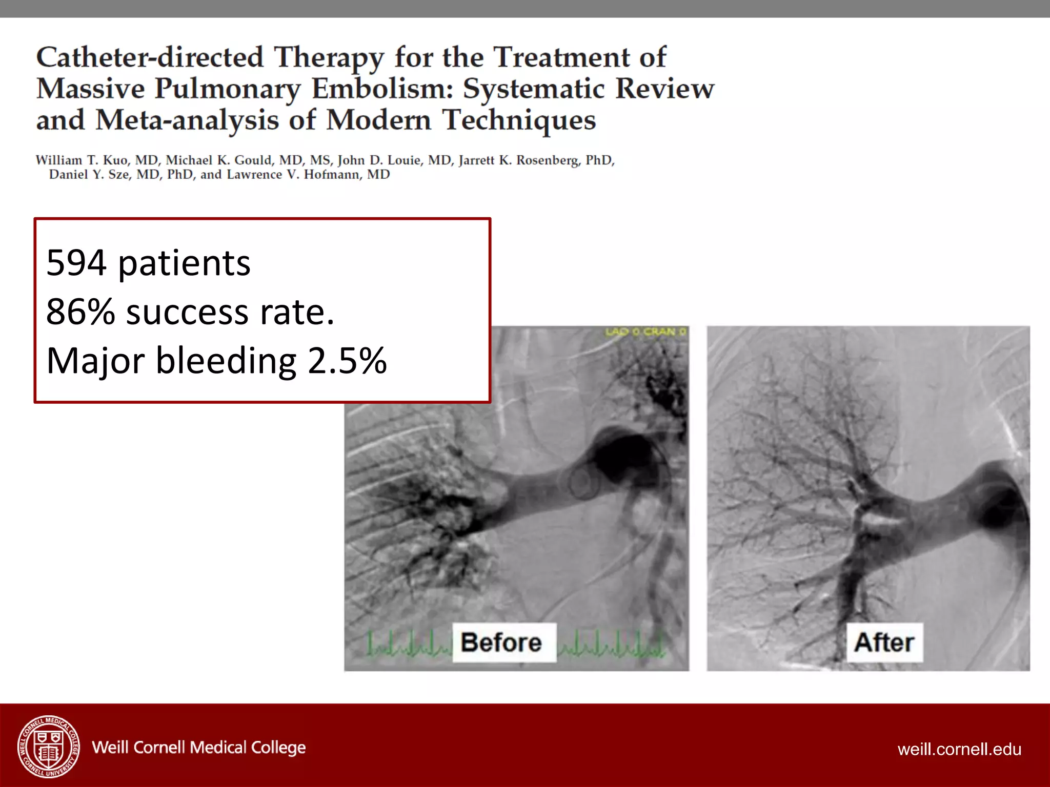 CLOT Team Treatment of Sub-Massive and Massive PE | PPT