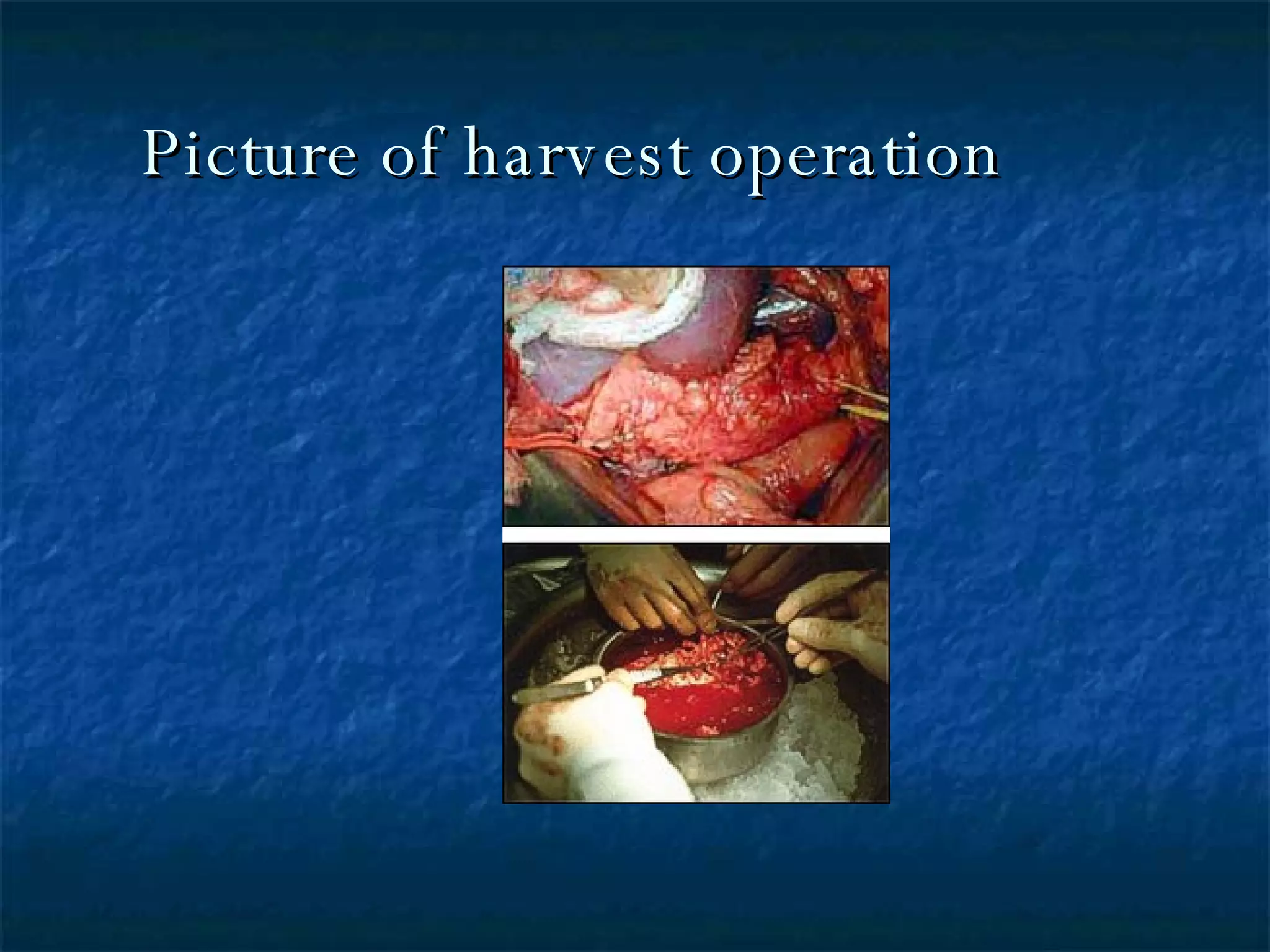 Organ Trafficking | PPT