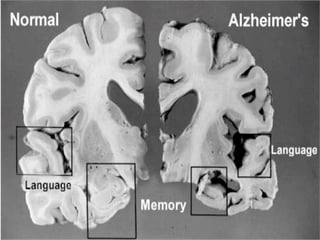 Organic brain syndrome | PPTX