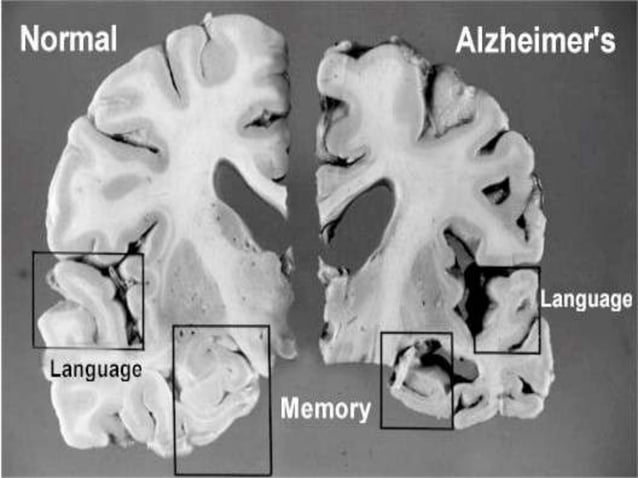 Organic brain syndrome | PPTX | Brain and Nervous System Disorders ...