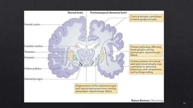 Organic brain syndrome | PPT