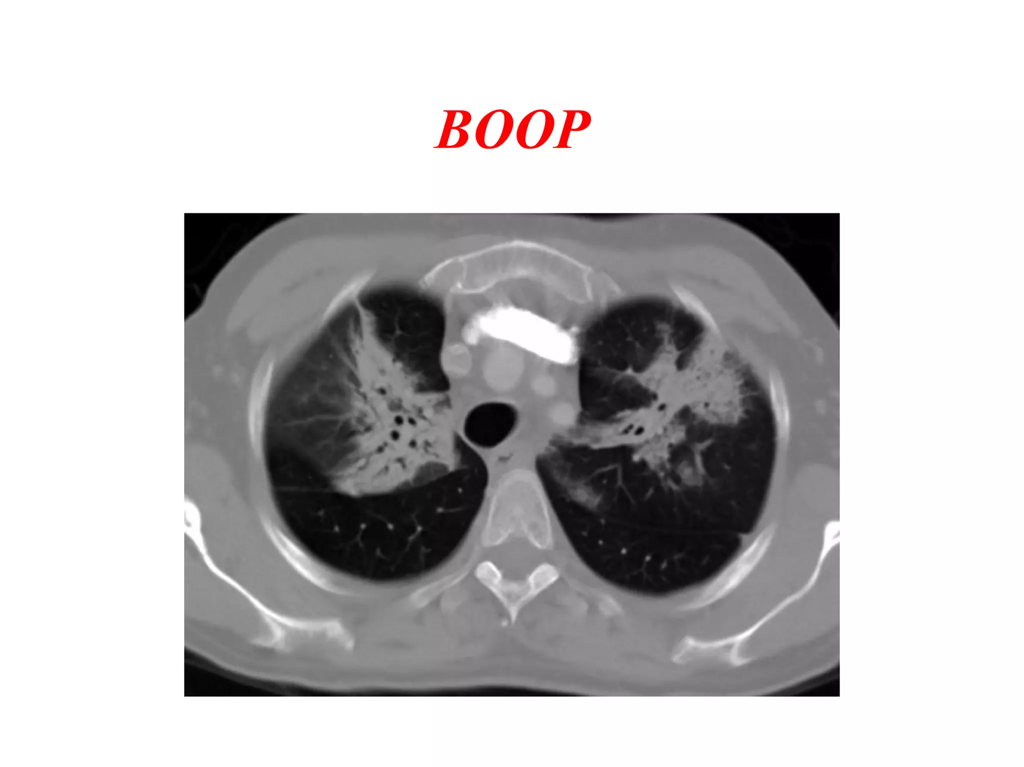 Organizing pneumonia | PPT