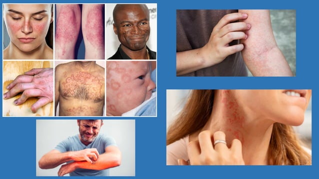 MANIFESTATIONS OF PSORA IN CHRONIC DISEASES.pptx