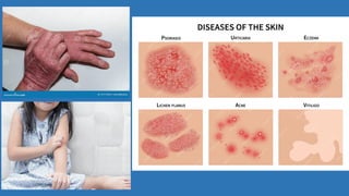 MANIFESTATIONS OF PSORA IN CHRONIC DISEASES.pptx