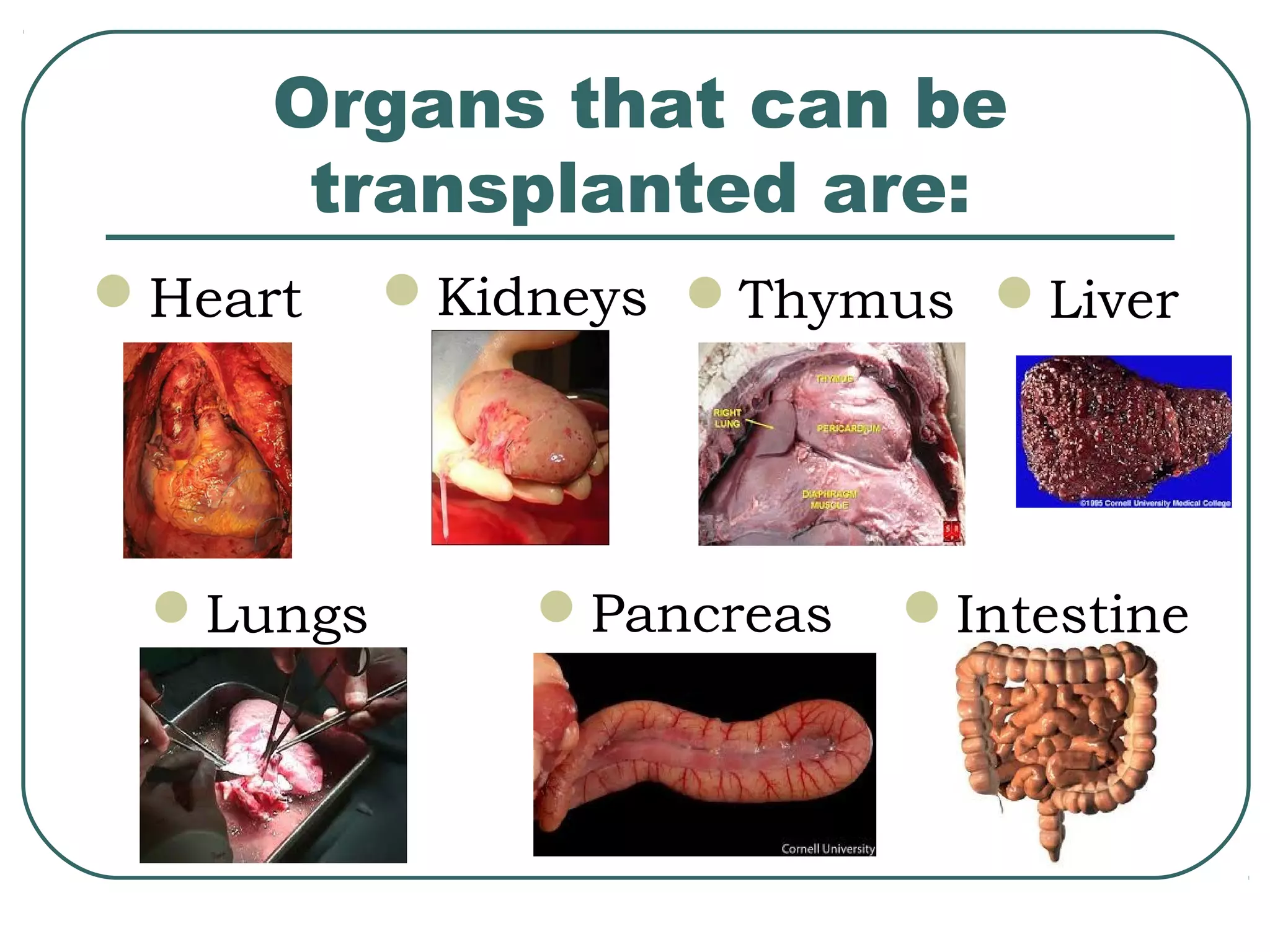 Organ transplantation | PPT