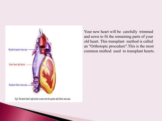 Organ transplantation ppt | PPTX