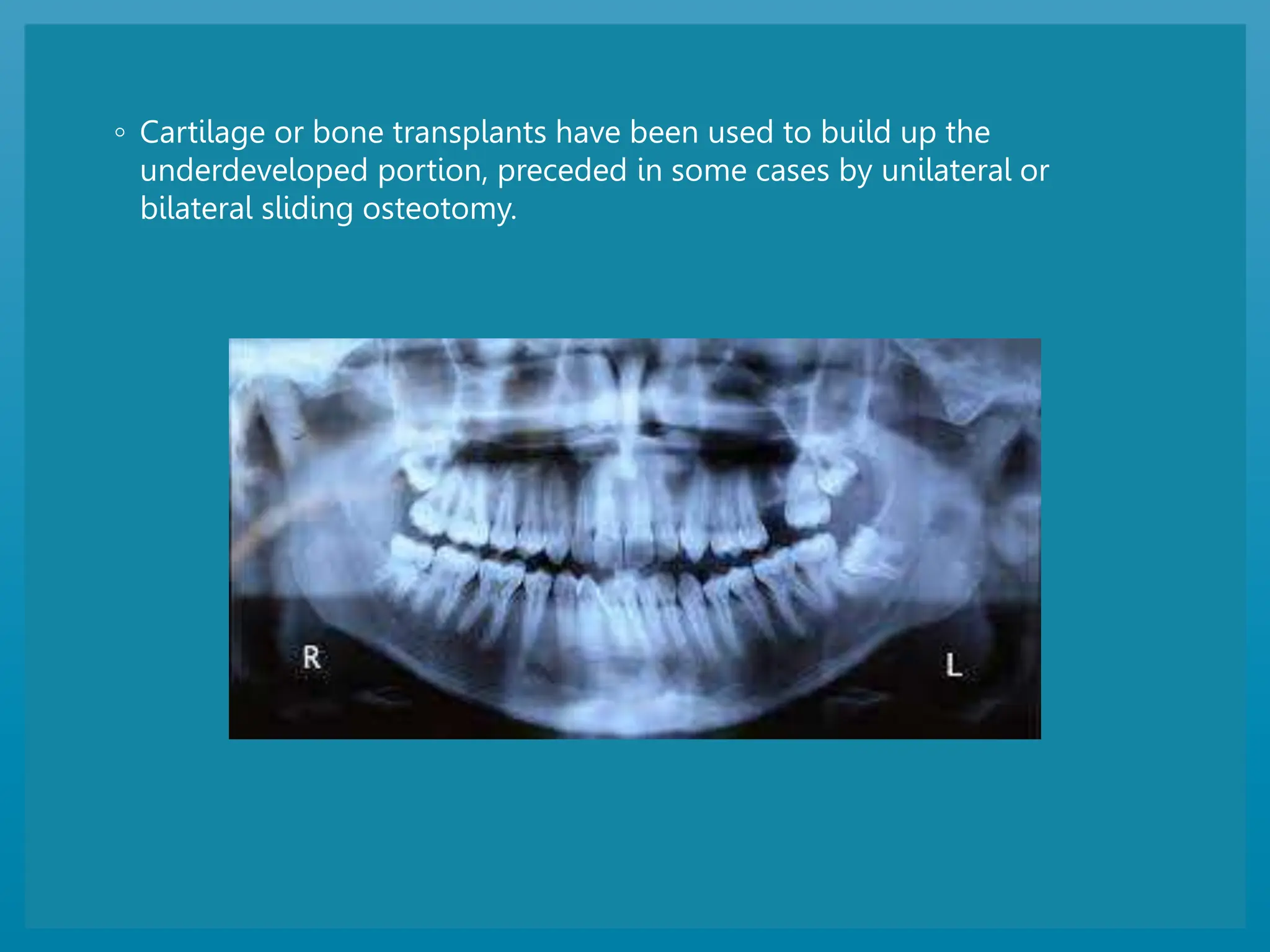 TMJ DISORDERS oral pathology seminar topics | PPTX