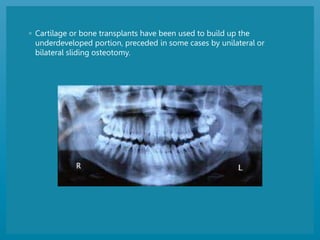 TMJ DISORDERS oral pathology seminar topics | PPTX