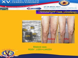 Orientated foam sclerosis | PPTX