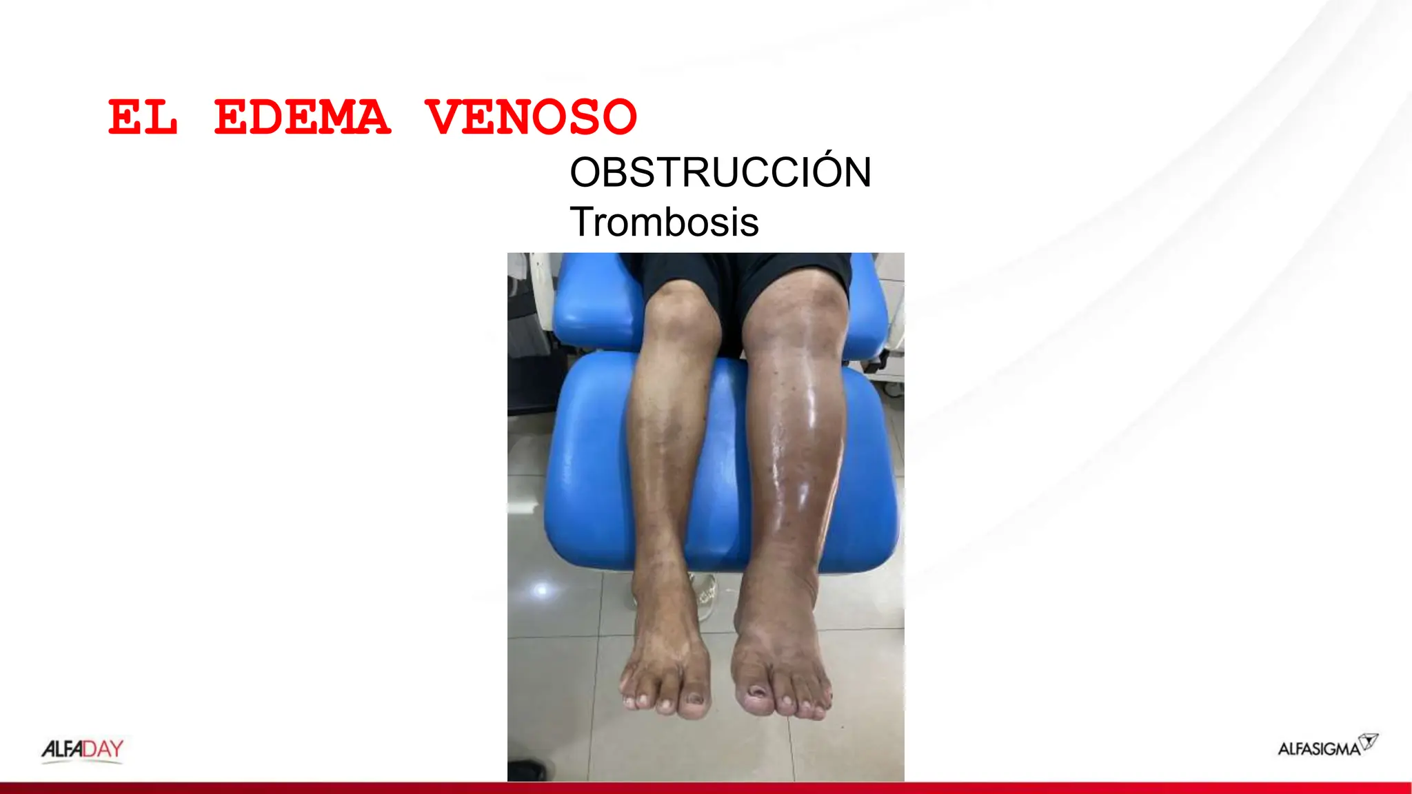 ORIGEN DEL EDEMA EN LA ENFERMEDAD VENOSACRONICA. pptx | PPT