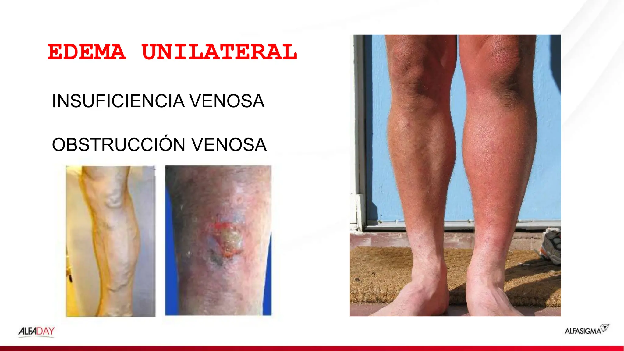 ORIGEN DEL EDEMA EN LA ENFERMEDAD VENOSACRONICA. pptx | PPT